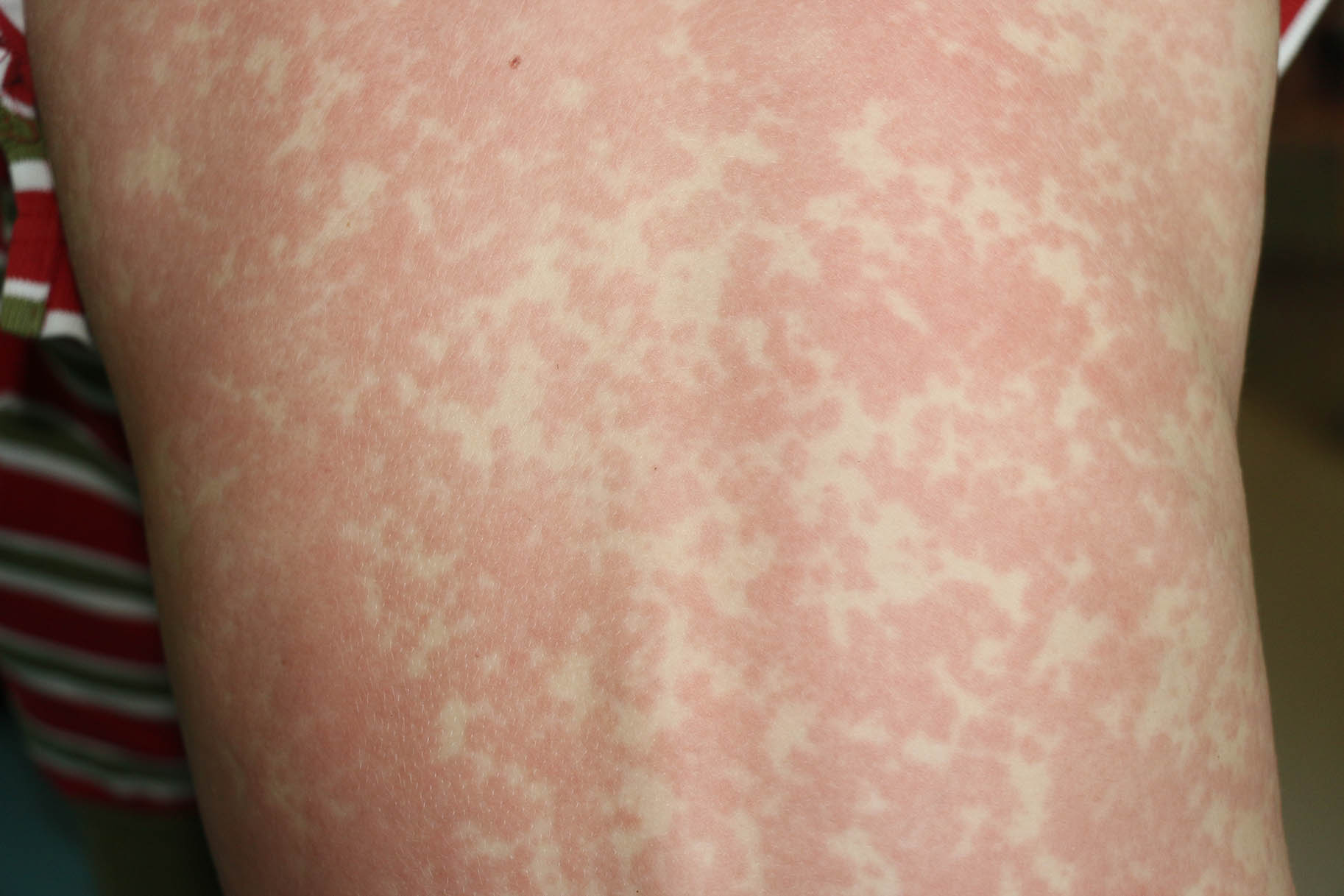 Morbillo - Amico Pediatra