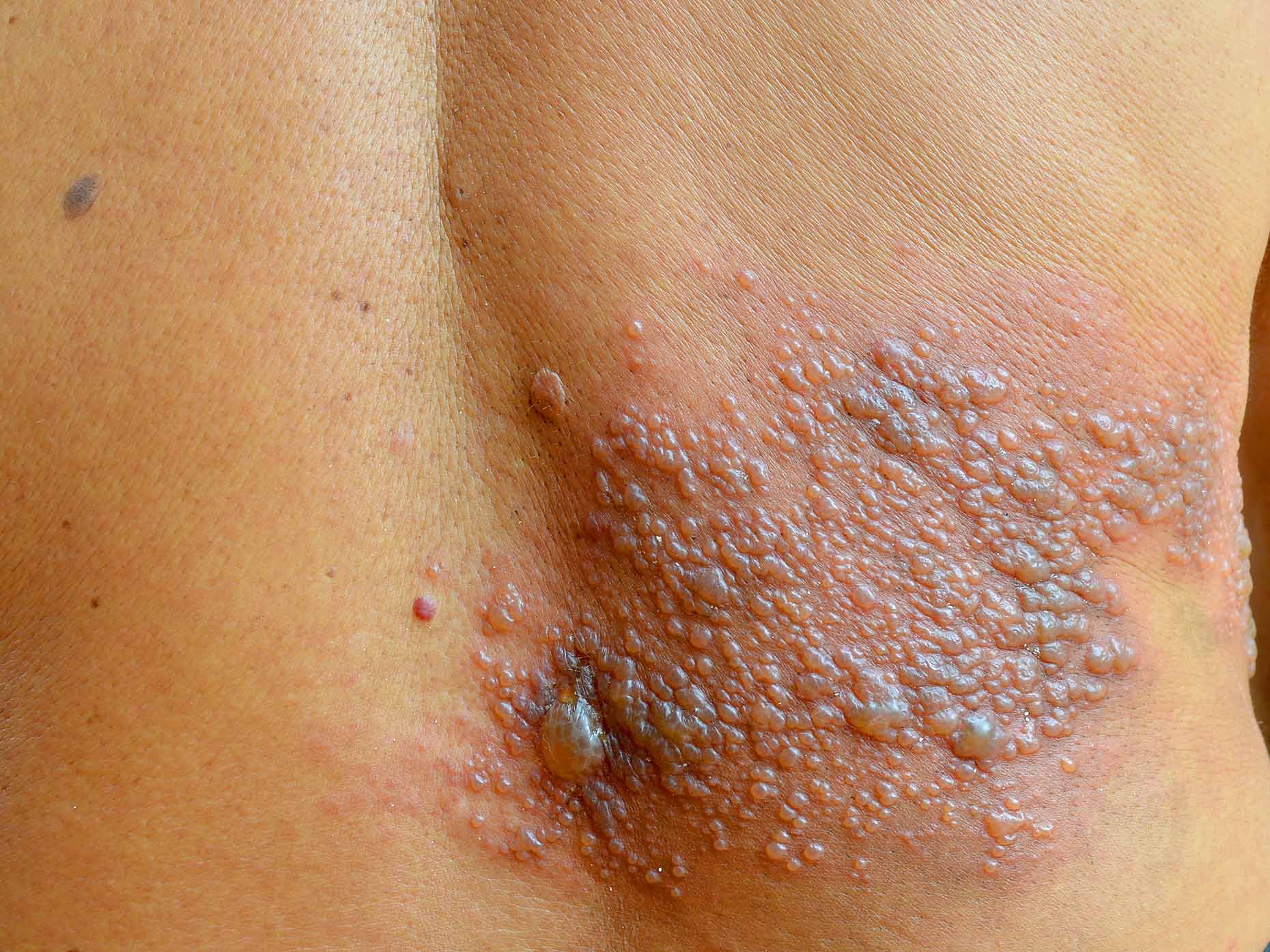 Herpes Zoster (Fuoco di Sant'Antonio) - Amico Pediatra
