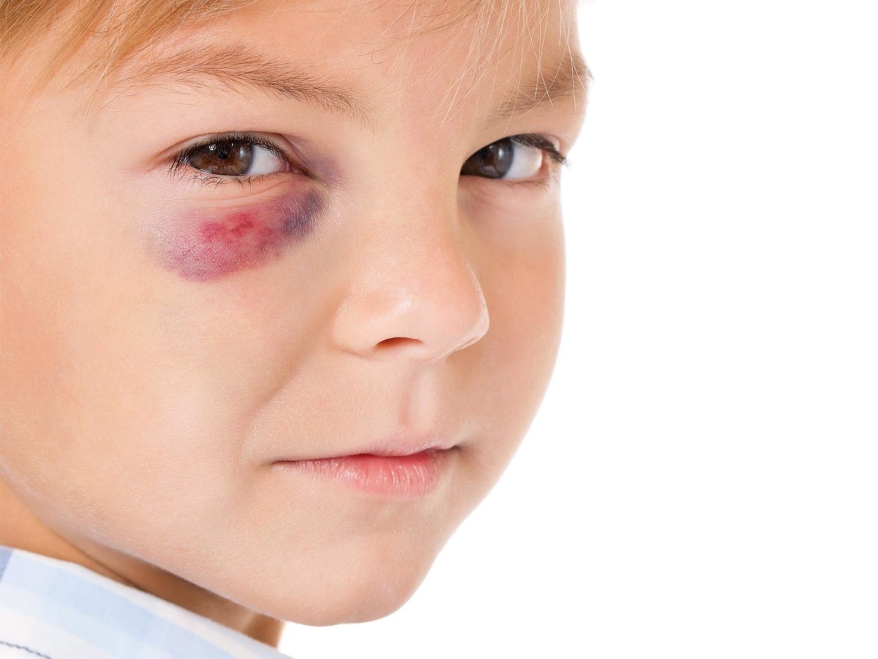 Ecchimosi (lividi) - Amico Pediatra