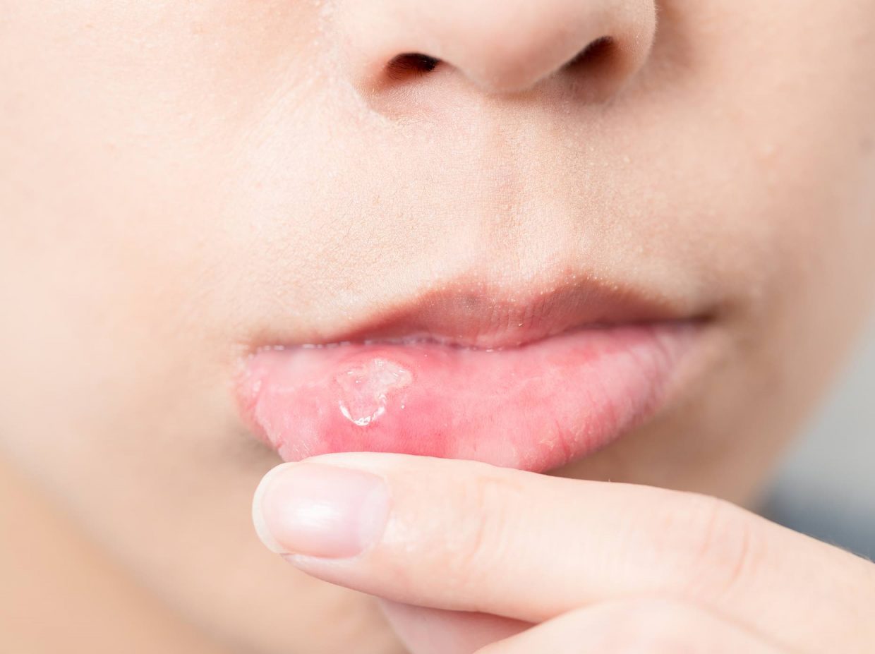 Afte nel bambino: cosa significano, cosa si può fare - Amico Pediatra