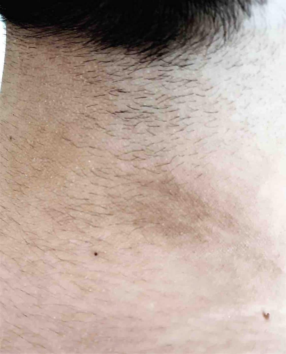 Macchie scure della pelle: non solo nei o lentiggini - Amico Pediatra