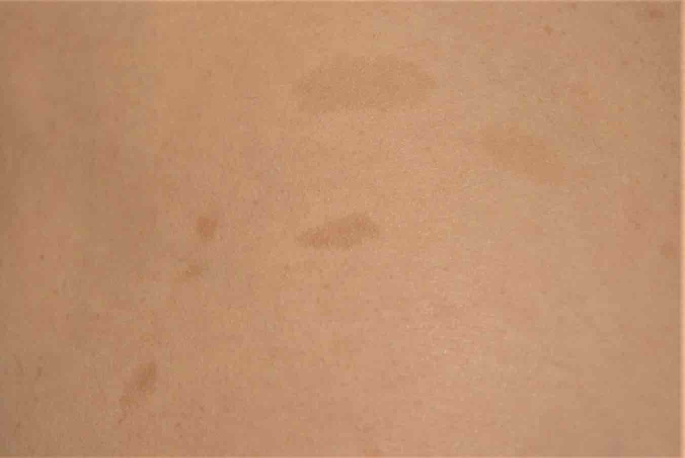 Macchie scure della pelle: non solo nei o lentiggini - Amico Pediatra