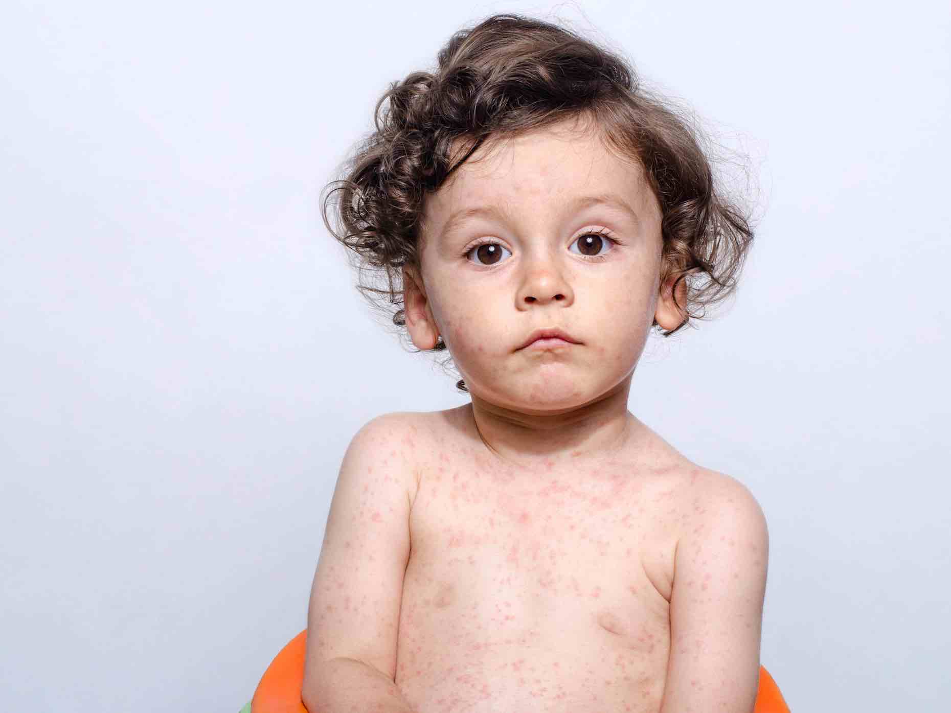 E' più pericoloso il morbillo o la vaccinazione anti-morbillo? - Amico ...