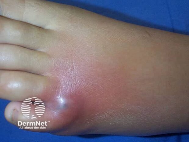 Morso di ragno - Amico Pediatra