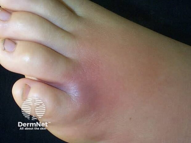 Morso di ragno - Amico Pediatra