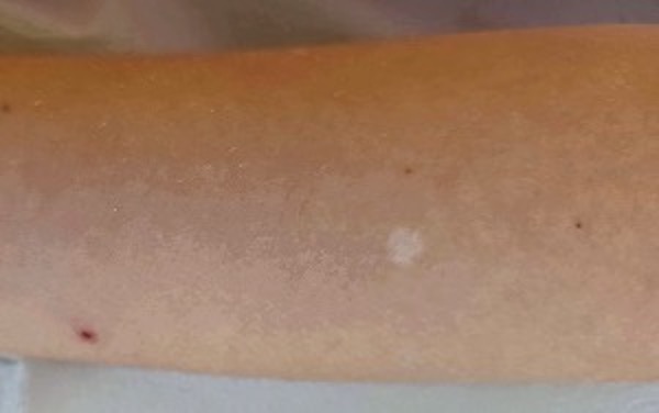 Macchie bianche della pelle: guida fotografica per genitori - Amico ...