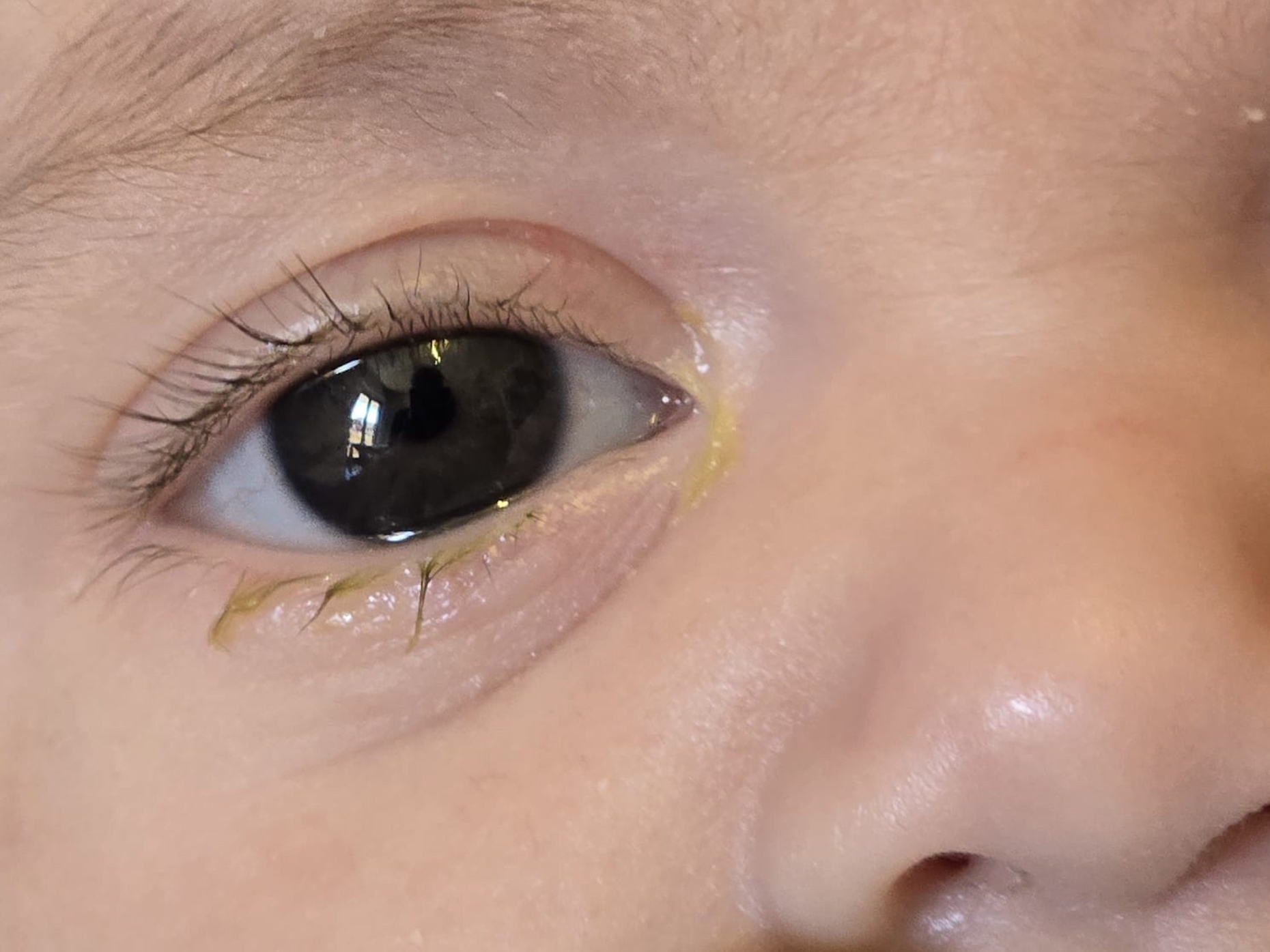 Occhio che “spurga” muco giallo nel neonato e nel bambino piccolo ...